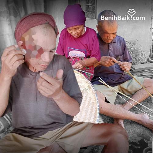 Kanker Ganas Merusak Mata dan Setengah Wajah Pak Koko, Tubuhnya Kurus ...