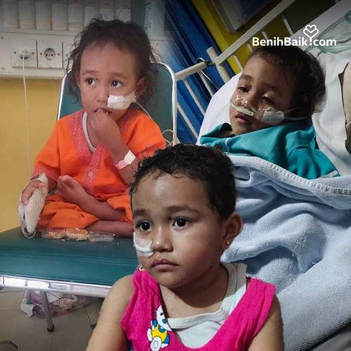 Penyempitan Esofagus dan Kurang Gizi, Razqya Harus Dibantu Selang NGT ...