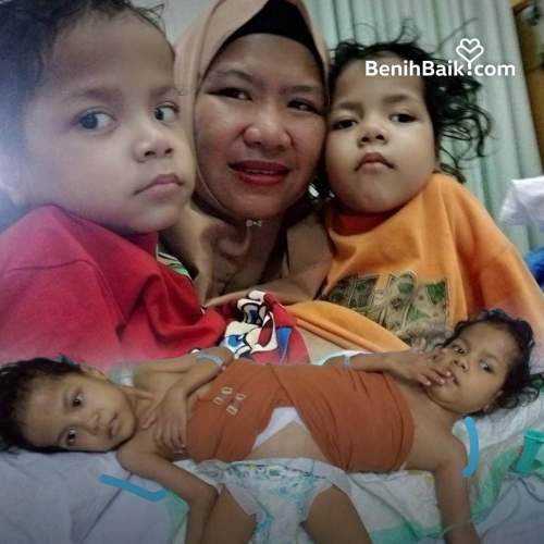 Kisah Pilu 2 Anak Kembar Siam, Tubuh Menyatu dan Harus Kehilangan Kaki ...