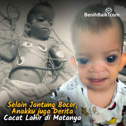 Selain Jantung Bocor, Anakku juga Derita Cacat Lahir di Matanya ...