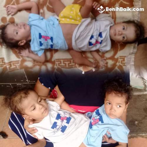 Anak Kembar Siam Butuh Biaya Operasional Pengobatan, Yuk Bantu ...